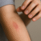 Does Itching Mean a Wound Is Healing? (Science-Based Guide) - Wound ...